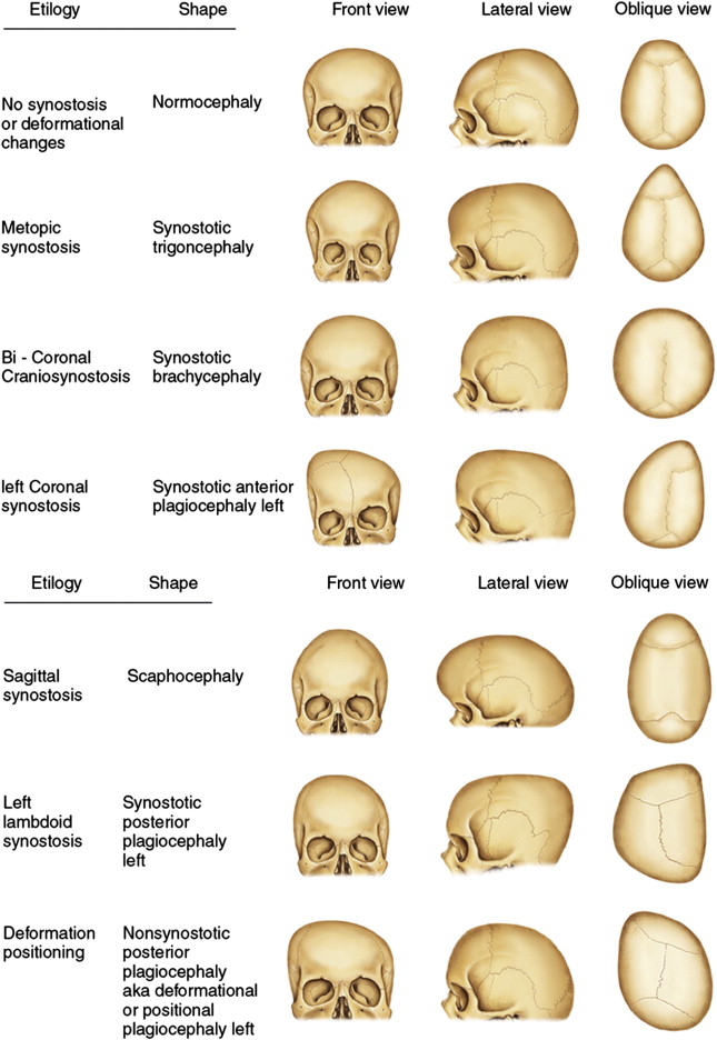 What are the causes and treatment options for scaphocephaly